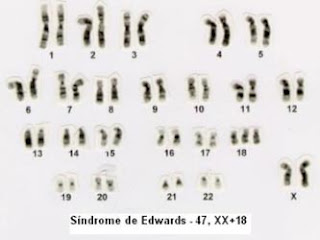 Biologia: Síndrome de Edwards: